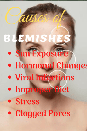 How To Get Rid Of Blemishes At Home [Home Remedies] - Beauty And ...